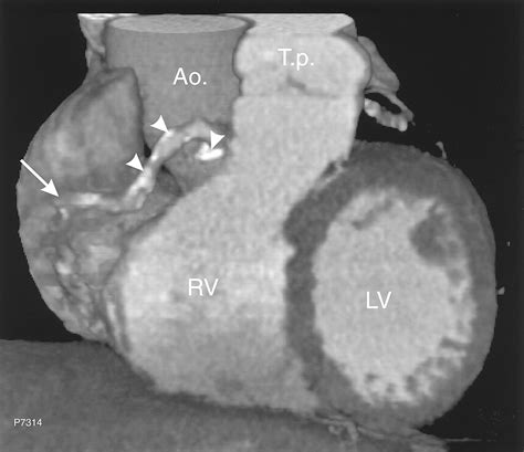 Noninvasive Detection Of Coronary Artery Stenosis By Multislice Helical