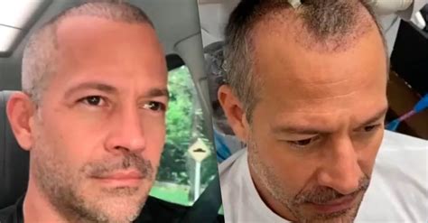 Malvino Salvador Compartilha Resultado Do Transplante Capilar