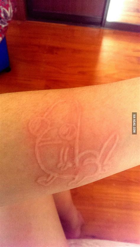 In Response To Fellow 9gagger With Dermatographic Urticaria 9GAG