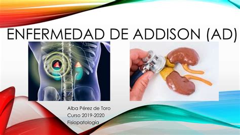 Enfermedad De Addison Alba P Rez Udocz