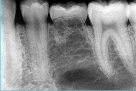 Abnormalities Of Teeth Flashcards Quizlet