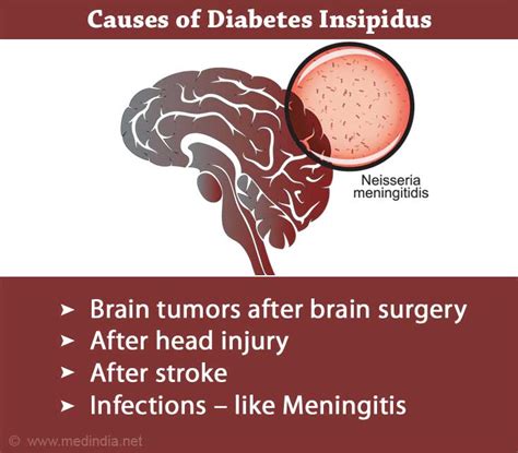 Diabetes Insipidus Causes Symptoms Diagnosis Treatment Complications