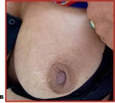 A B Depicts Painless Soft Breast Mass On Left Quter Quadrant