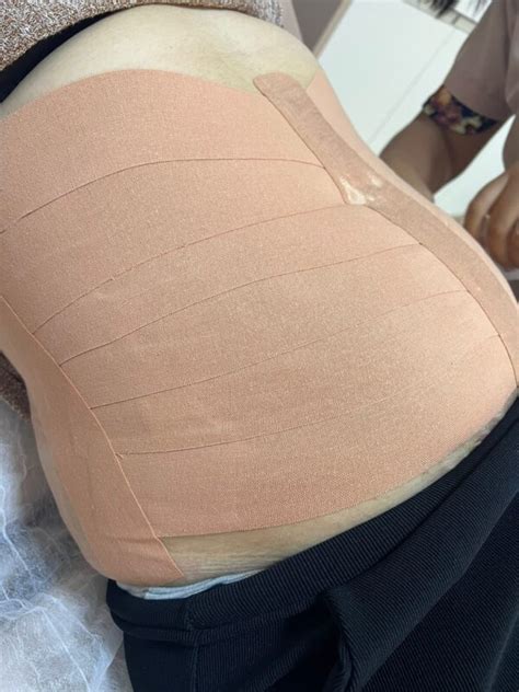 Por que usar o Taping no pós parto Clínica Fortius