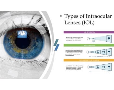 What Is The Best Lens For Your Cataract Surgery Cataract Patients
