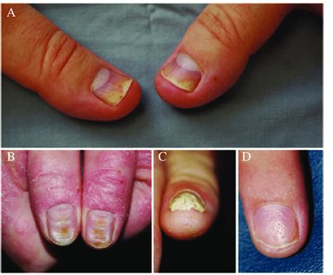 Nail Changes In Psoriatic Arthritis PsA A Onycholysis B