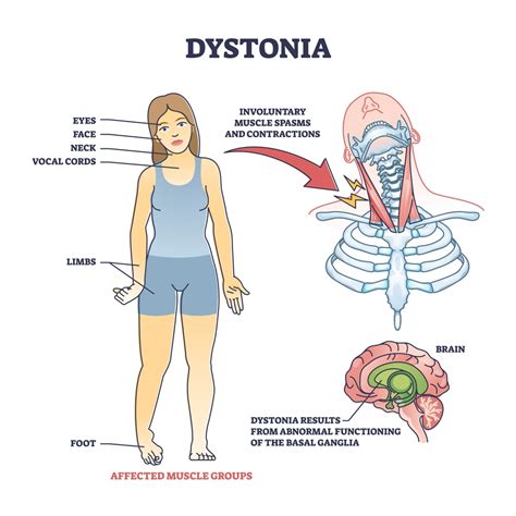 Dystonia Treatment In Mumbai Dr Gurneet Sawhney