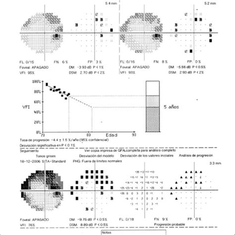 Pdf Glaucoma Progression Detection Agreement Sensitivity And