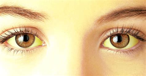Olhos Amarelados O Que Pode Ser