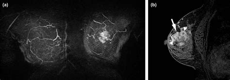 descriptors of malignant non mass enhancement of breast mri academic radiology