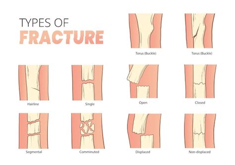 Tipos De Fracturas De Huesos Vector Premium