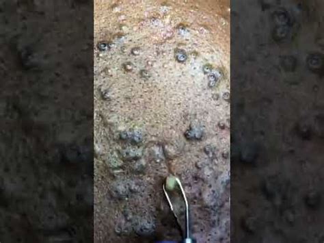 Blackheads Loan Nguyen 2022 Pimple Popper Cyst Pop YouTube