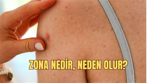 Zona Nedir Belirtileri Ne Neden Olur Zona Nasıl Geçer Hürsöz Gazetesi