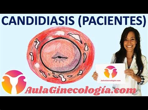 CANDIDIASIS VAGINAL PACIENTES Causas síntomas tratamiento