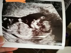 Gender Guess 12 Week Scan Mumsnet