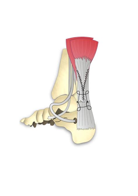 Rupture Ancienne Du Tendon D Achille Dr Bovier Lapierre