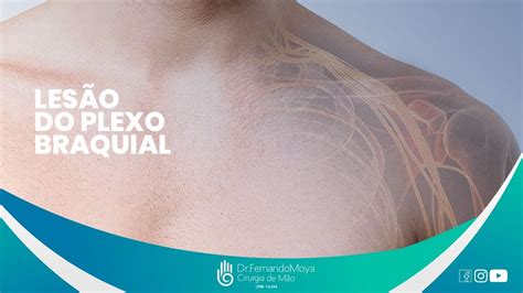 Les Es Do Plexo Braquial O Que S O Causas E Tratamento Dr Fernando