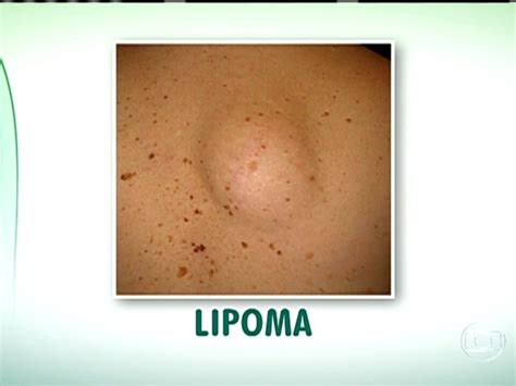 Bem Estar Lipoma é um tumor benigno e não representa risco Globo Play