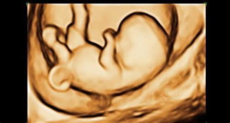 Idade Gestacional Fetalmed Medicina Fetal Em Curitiba