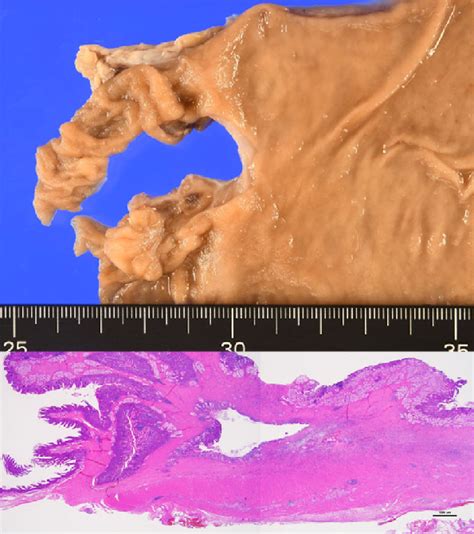 Figure The Macroscopic And Microscopic Findings Of The Resected