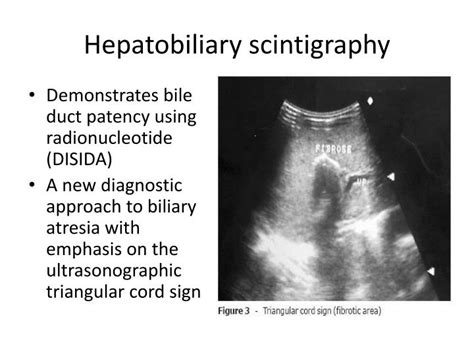 PPT Biliary Atresia PowerPoint Presentation ID 3125670
