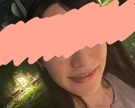 歯列矯正レポ⑤抜歯矯正による頬コケで病む コスパ美人