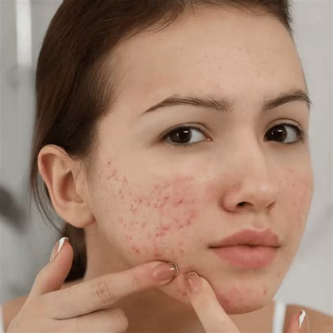 Acne The Recovery Hub Adelaide