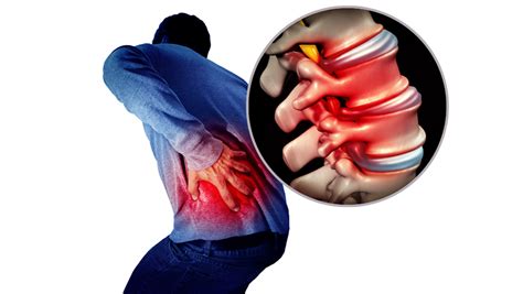 Quiropráctico hernia discal Barcelona Tratamiento protrusión
