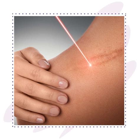 Tratamiento para quitar cicatrices con láser Lina María Llanos