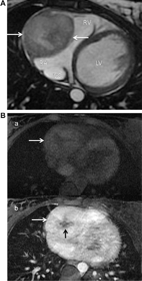 E A Cardiac MRI Axial Steady State Free Precession SSFP Image