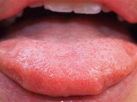 Por Qu Aparecen Peque Os Puntos Rojos En La Lengua Blog Dental Irriak