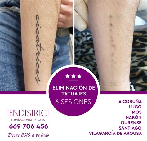 Láser para quitar tatuajes en A Coruña Tendistrict