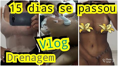 Abdominoplastia Mastopexia Prótese 15 dias de Operada YouTube