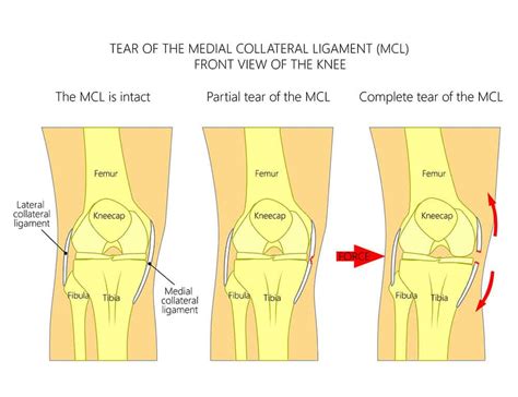 MCL Sprain Recovery Time Injury Health Blog