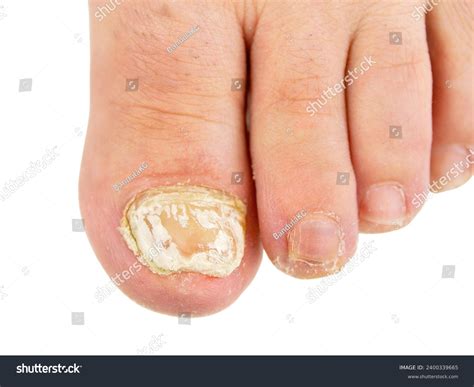Onychomycosis Onycholysis Paronychia Nail Diseases Nail Stock Photo