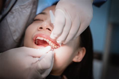 What Does A Blood Clot Look Like After Tooth Extraction Didsbury