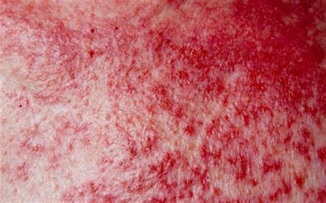 Cancers De La Peau Une Progression Inqui Tante Chez Les Jeunes Adultes