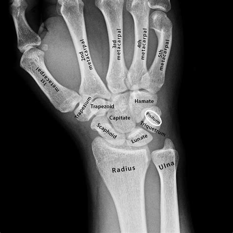 Handwurzelknochen Definition Lage Anatomie Diagramm Fyzgy