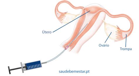 Inseminação artificial ou Inseminação intrauterina