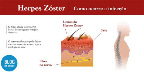 Como Funciona O Tratamento Para Herpes zóster Blog Da Saúde