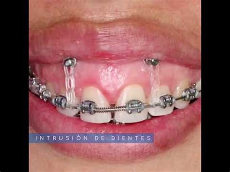 Microtornillos En Ortodoncia Son Utilizados En Casos Como Te Mostramos