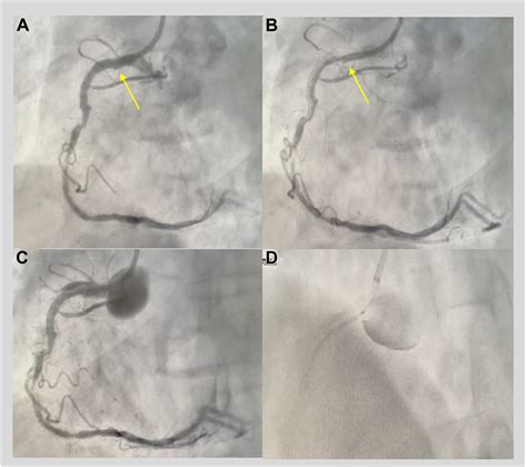 Iatrogenic Aortocoronary Dissection During Right Coronary Artery