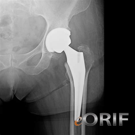 List 91 Pictures Photos Of Anterior Hip Replacement Scars Sharp