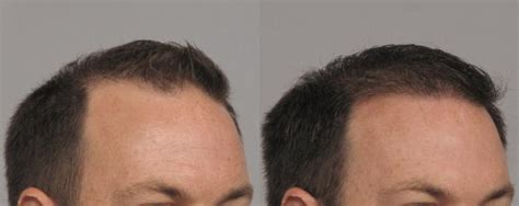 Fue Results Achieved With Smartgraft Or Neograft Before And After Photo