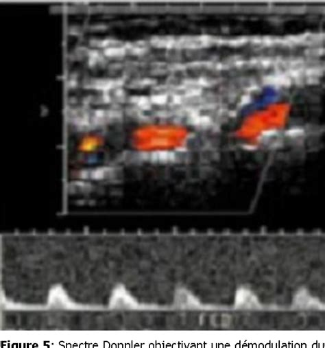 Figure 5 from Apport de lécho doppler artériel des membres inférieurs