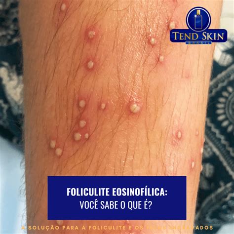 Foliculite Eosinofílica Você Sabe O Que é