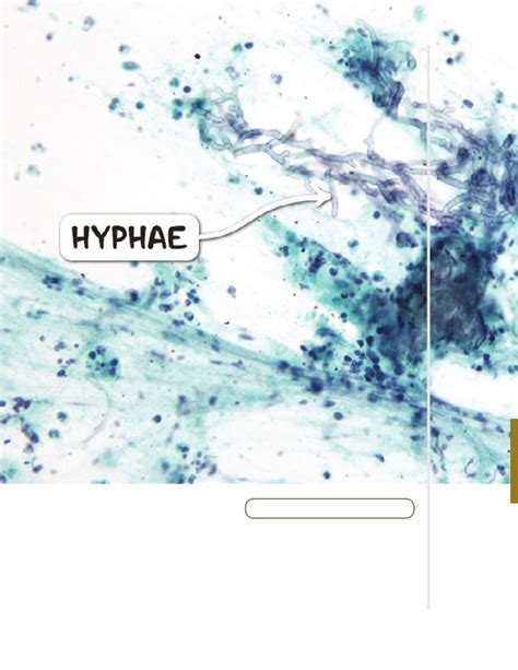 Opportunistic Fungal Infections Notes Diagrams Illustrations Osmosis