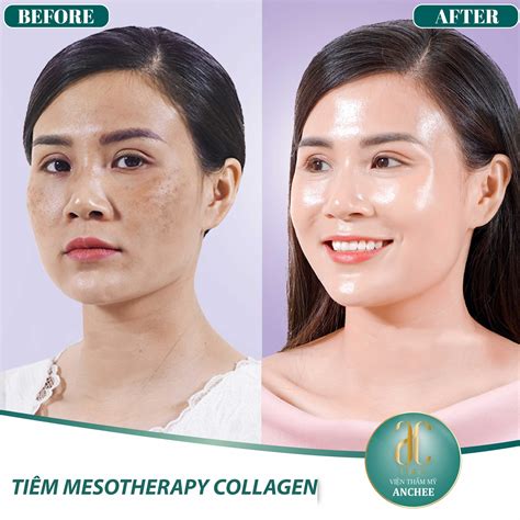 Tiêm Meso Giá Bao Nhiêu Báo Giá Tiêm Mesotherapy Chi Tiết