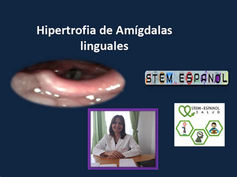 Puntuación De Hipertrofia Amigdalina