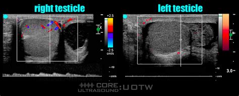 Testicular Torsion Ultrasound